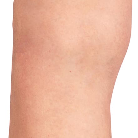 Varicose Vein and Thread Vein diagnostic & treatment | NL Clinic