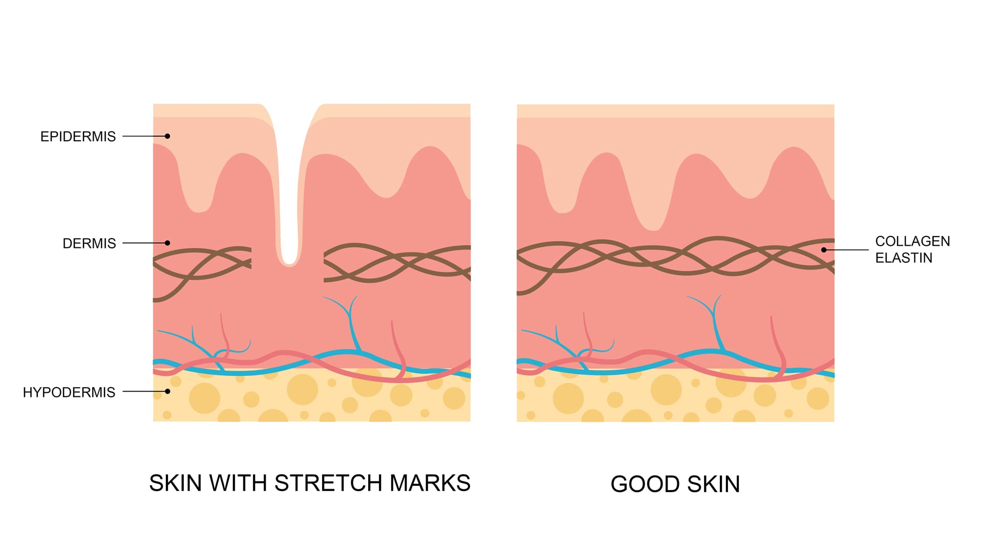 Stretch Mark Removal Treatments | NL Clinic