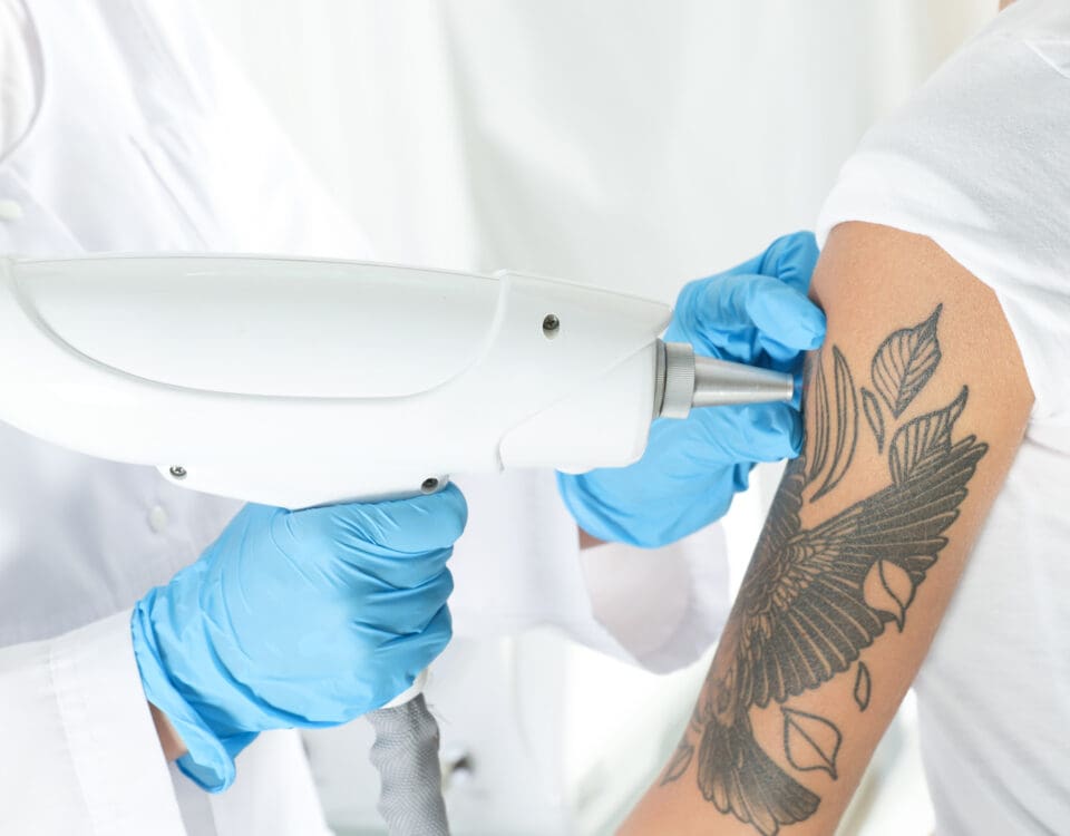 Tattoo Removal with Pico Laser for all colours | NL Clinic