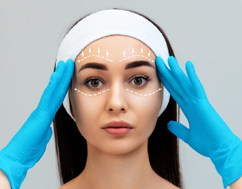 PDL Facial Threading with Silhouette Soft | NL Clinic