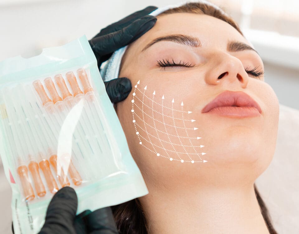PDL Facial Threading with Silhouette Soft | NL Clinic