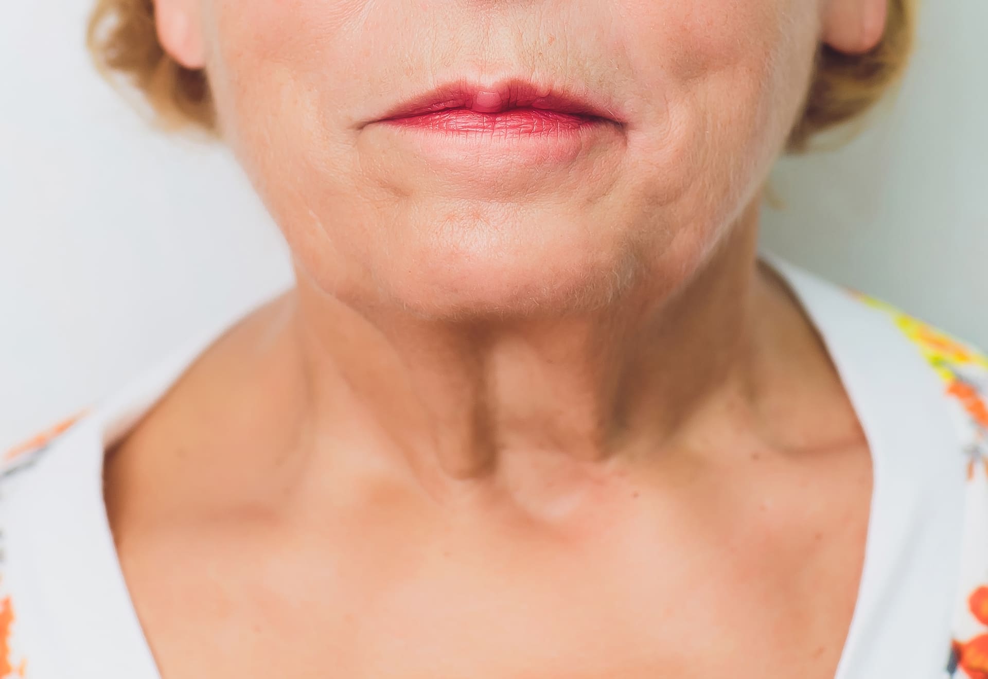 PDL Facial Threading with Silhouette Soft | NL Clinic