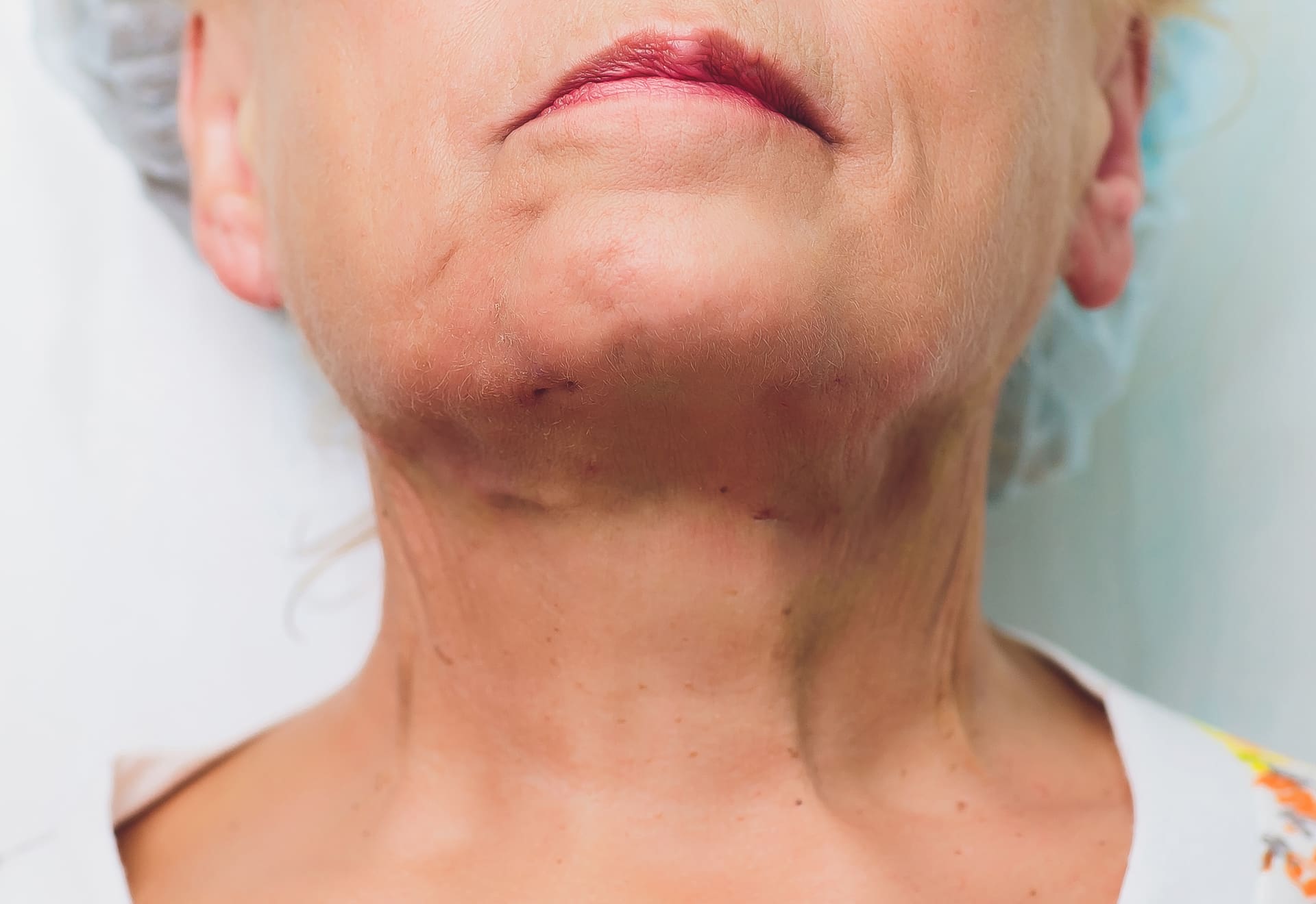 PDL Facial Threading with Silhouette Soft | NL Clinic