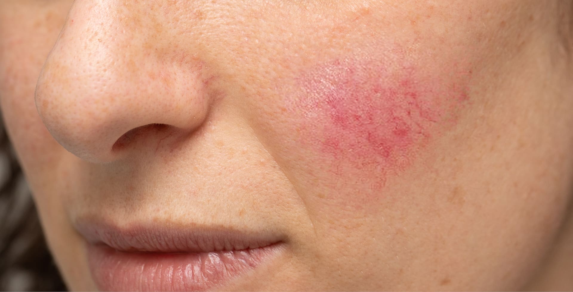 Rosacea - Photo-Rejuvenation & Skin Care Treatment | NL Clinic