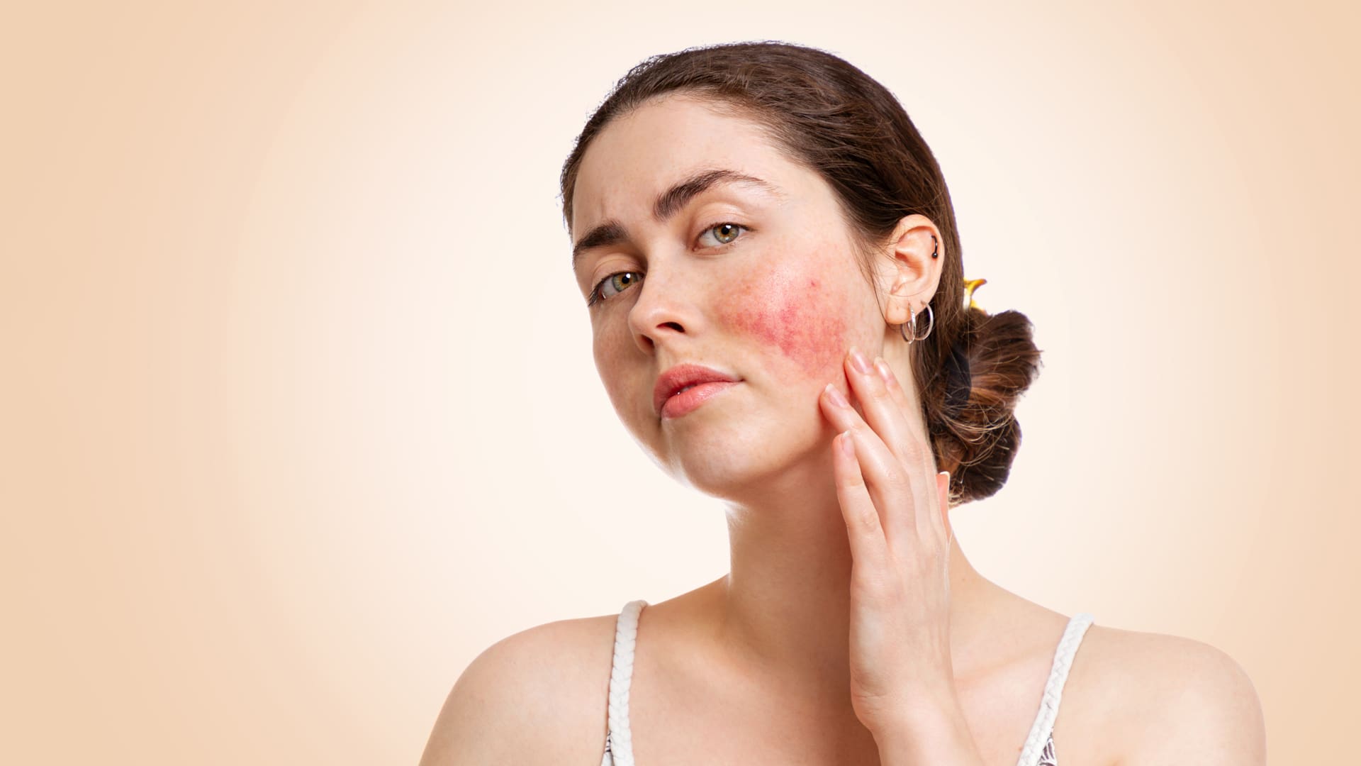 Rosacea - Photo-Rejuvenation & Skin Care Treatment | NL Clinic