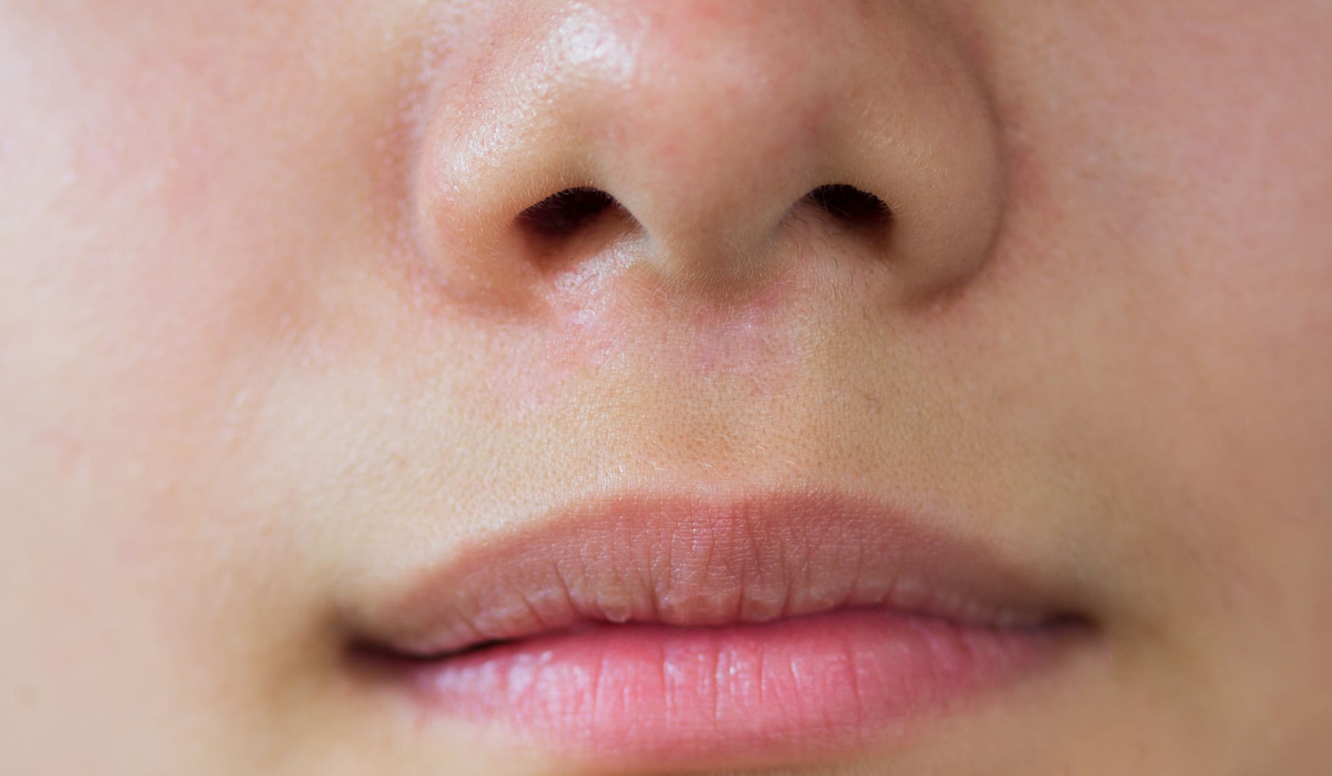 Scar Removal - Treatment with Dermal Roller and more | NL Clinic