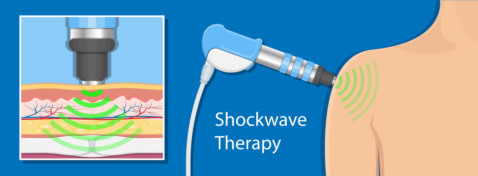 Shockwave - Treatment for joint and muscular pain I NL Clinic