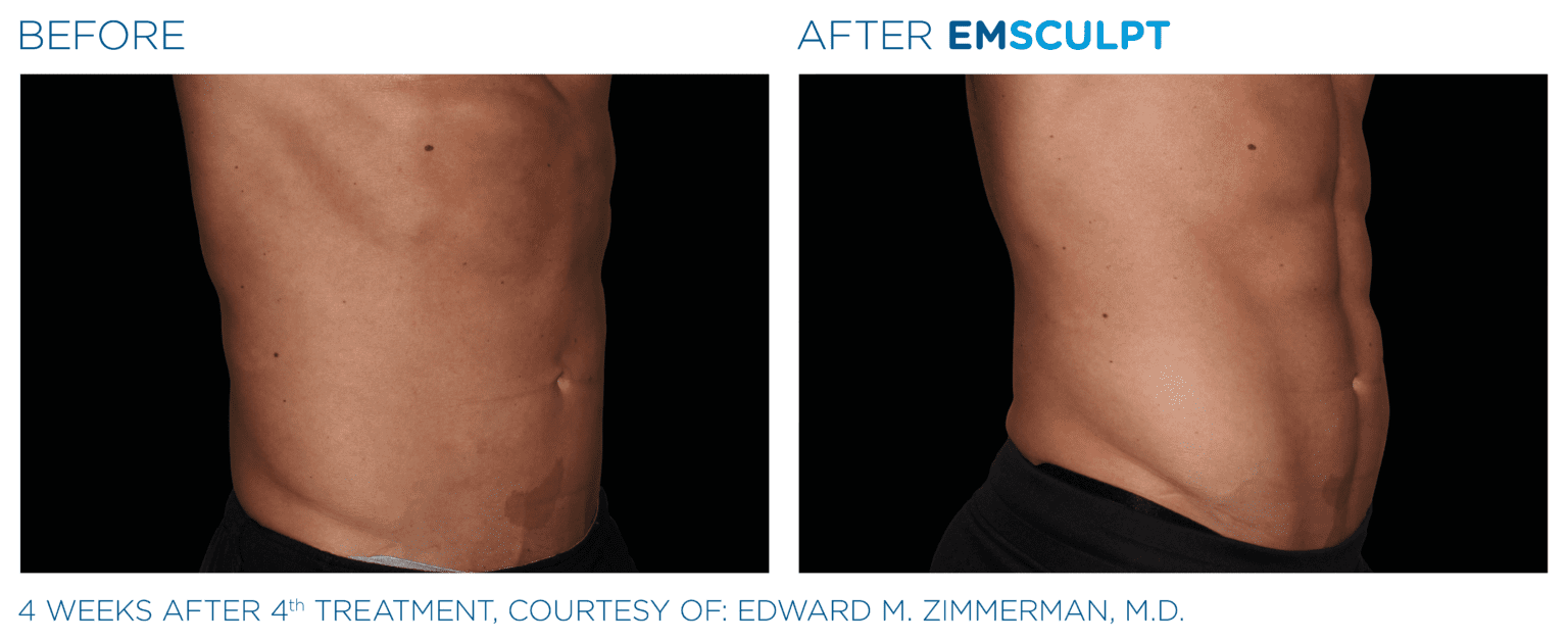 What is EMSCULPT | How Does It Help me Lose Weight?